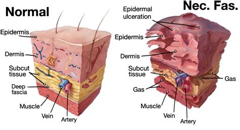 Necrotising Fasciitis