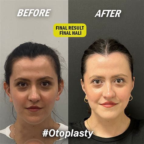 Otoplasty In Turkey Non Surgical Scarless Under Local Anesthesia
