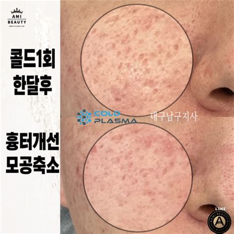 대구여드름흉터 패인여드름흉터로 인한 스트레스 해결 방법 네이버 블로그