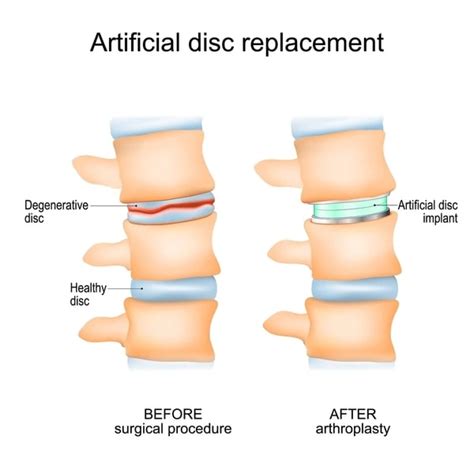 Is Artificial Disc Replacement Safe What You Need To Know