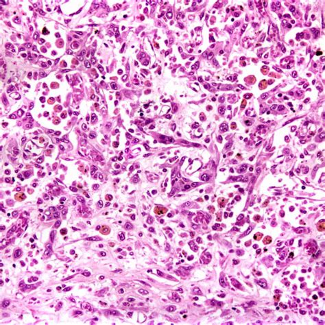 Angiosarcoma Liver Arsenic