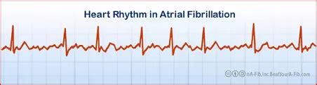 Atrial Fibrillation Flashcards Quizlet