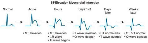 St Elevation St Elevation Ekg Elevation