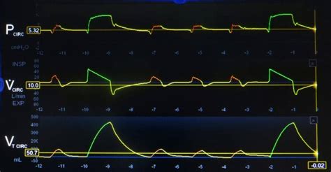 Understanding Ventilator Basics And Ventilator Waveforms Rt