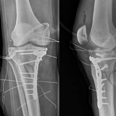 Post Operative X Rays Following Orif With Plate And Screws And Bone