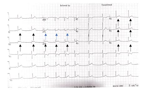 Constrictive Pericarditis Ecg Constrictive Pericarditis Ecg