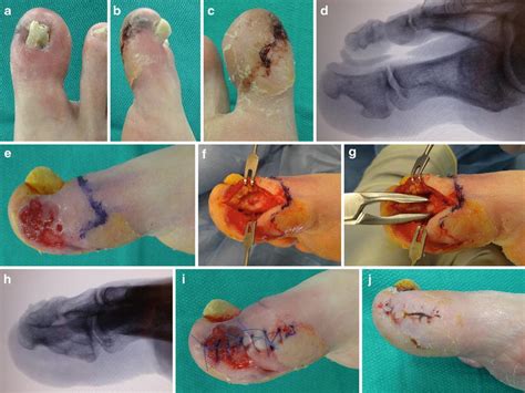 Bone Biopsy Techniques Musculoskeletal Key