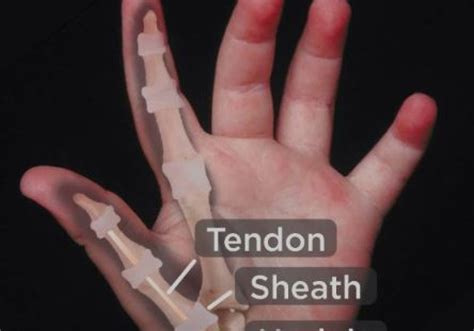A1 Pulley Release Thumb Hand And Nerve Surgeon