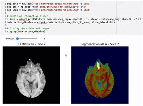 The Ultimate Guide To Medical Image Segmentation With Deep Learning 2d And 3d