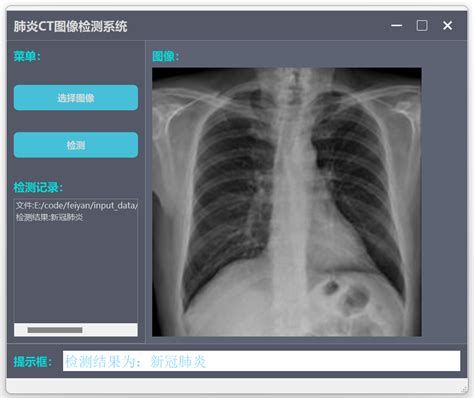 基于深度学习 resnet vgg 肺炎ct图像检测诊断系统 ui界面 索炜达 猿创