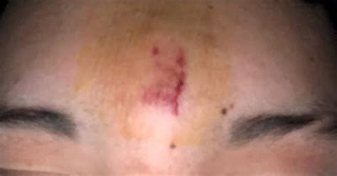 Rosario Un Docente Le Arrojó Un Borrador A Un Alumno Para Callarlo Le Lastimó La Frente Y Fue