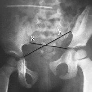 Method For Measuring Pelvic Tilt Described By Keshishyan Et Al 5 In Download Scientific