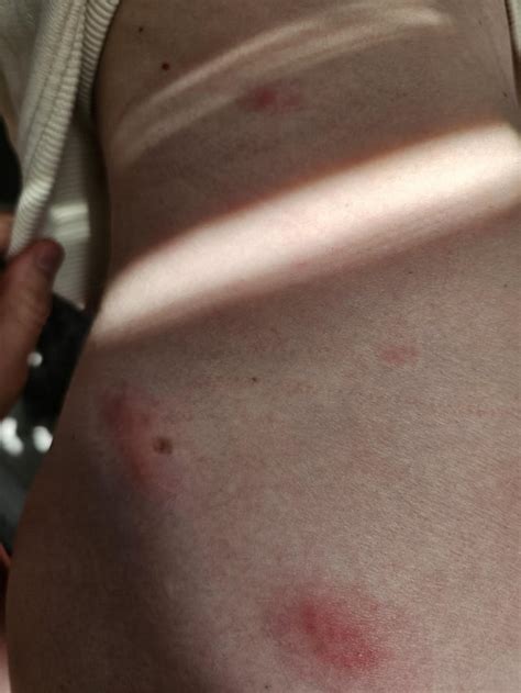 What Is This Rash Bugbites R Medical Advice