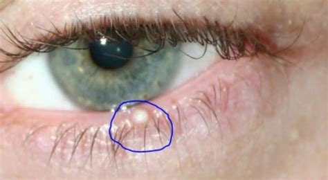 Eyelid Infection