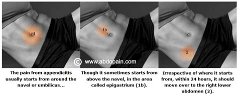 Appendix Pain Location Where Appendicitis Pain Starts From And Stays