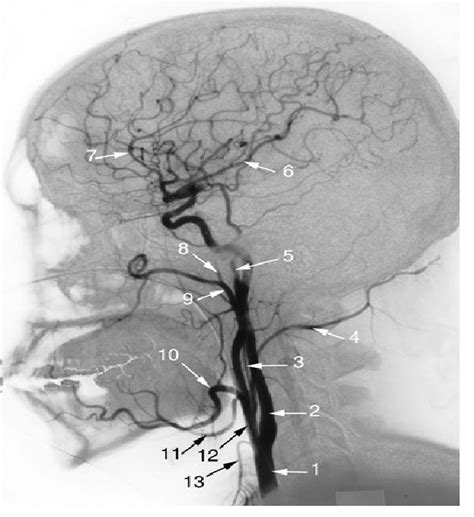 Angiogram Lateral View Diagram Quizlet
