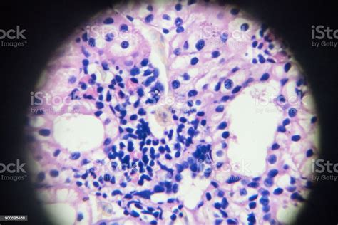 현미경 검사 법에서 단층 입방체 상피 보기 편평세포 암종에 대한 스톡 사진 및 기타 이미지 편평세포 암종 피부 건강 진단 Istock