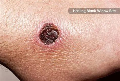 Black Widow Spider Bite Effects