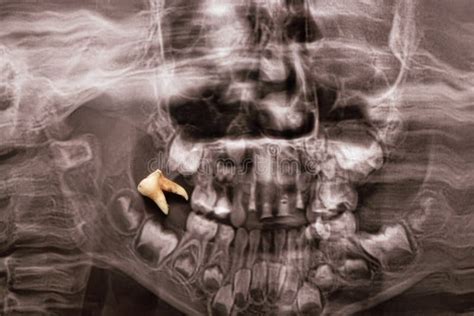 A Panoramic Image Shows Several Embedded And Impacted Teeth As On The