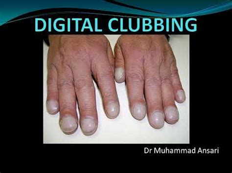 Digital Clubbing Grades And Causes Of Clubbing Youtube