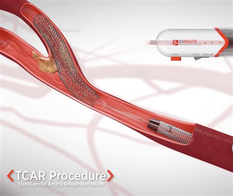 Transcarotid Artery Revascularization Tcar