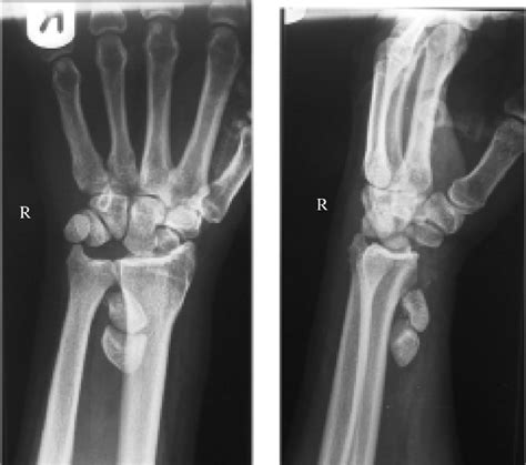 Scaphoid Dislocation