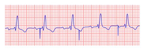 Fileventricular Undersensingsvg Ecgpedia