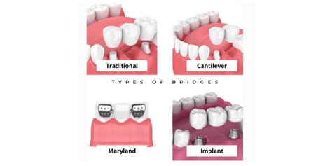 Types Of Dental Bridges