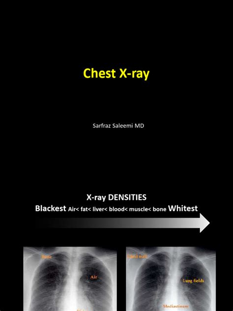 Chestx Ray 180216035142 Pdf X Ray Imaging