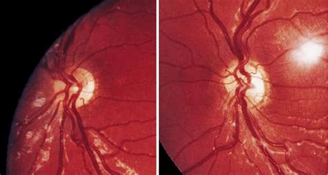 Fundus Photograph Of Patient 4 Showing An Optic Disc With No Sign Of