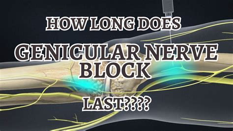 How Long Does Genicular Nerve Block Last Tipss