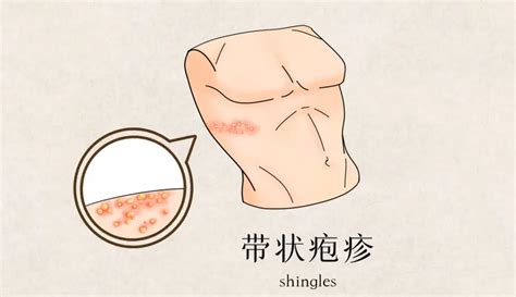 科普小知识：病毒性疱疹（蛇缠腰）珠海禅诚医院【官网】