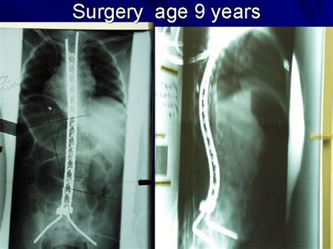 Growing Segmental Spinal Instrumentation Without Fusion In Spinal