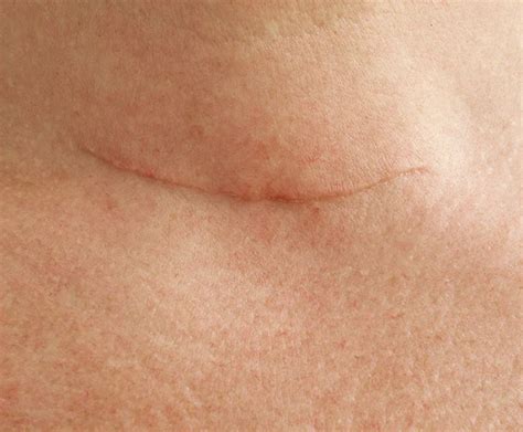 Laspect De La Cicatrice Chirurgie Thyroïde Paris