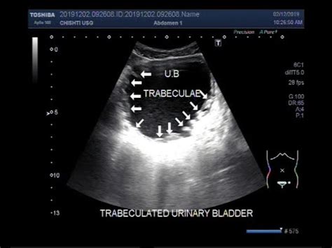 Ultrasound Video Showing Trabeculation Of The Urinary Bladder Youtube