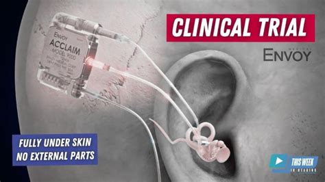 Sameh Zenhom On Linkedin Fully Implanted Cochlear Implant Clinical Trial To Take Place At Mayo