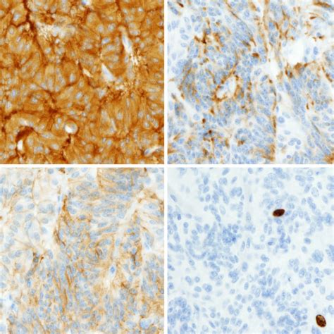 Figure7endoscopic Papillectomy For G1 Net Of The Ampulla Of Vater A