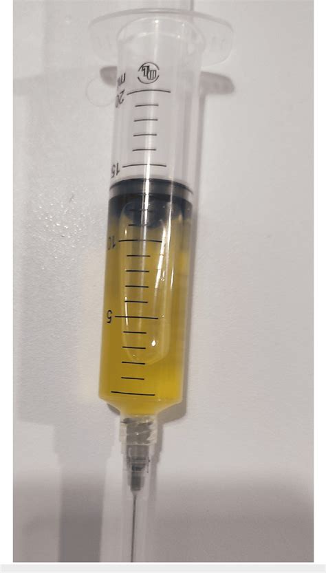 Figure 1 From Idiopathic Chylothorax During Pregnancy A Case Report