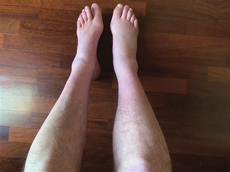 Right Leg Showing Deep Vein Thrombosis Signs Informed Consent For The