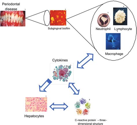 Biological Plausibility Diagram That Periodontal Infection May Increase Download Scientific