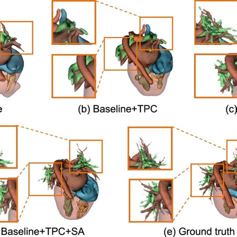 3d Visualisation Of The Ablation Results On The Imagechd Database Download Scientific Diagram