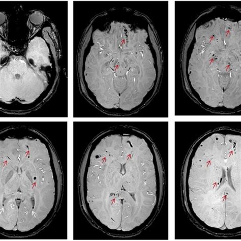 Mri Of A 17 Year Old Male With Traumatic Axonal Injury Three Days Post
