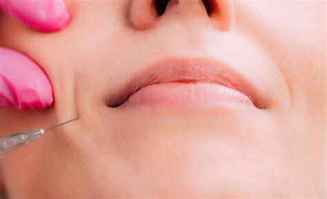 Pdo Threads For Lips Vs Lip Filler Which One Is Better