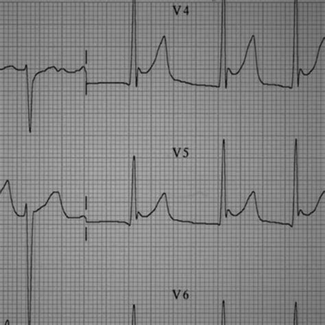 Bradycardias Rcemlearning India Bradycardias Rcemlearning India