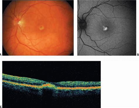 Fundus Autofluorescence In Pattern Dystrophy Ento Key