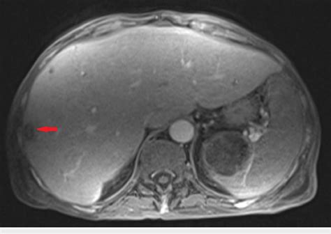 Mri Of The Liver Showing A Nodular Hepatic Lesion Red Arrow