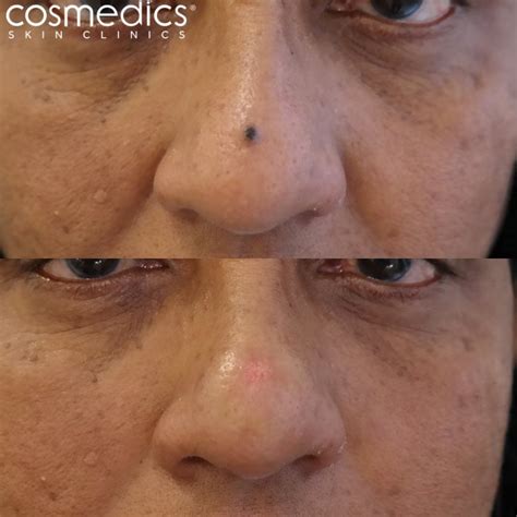 Mole On Face Removed Mole Removal London Top Plastic Surgeon