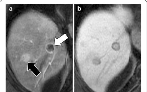 A 73 Year Old Man With Colon Cancer And Liver Metastases Gadobenate