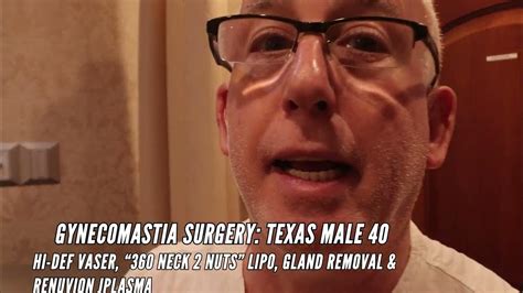 Gyncomastia Surgery Lebo Gyno And Beyond Texas Male 40 Hi Def Vaser