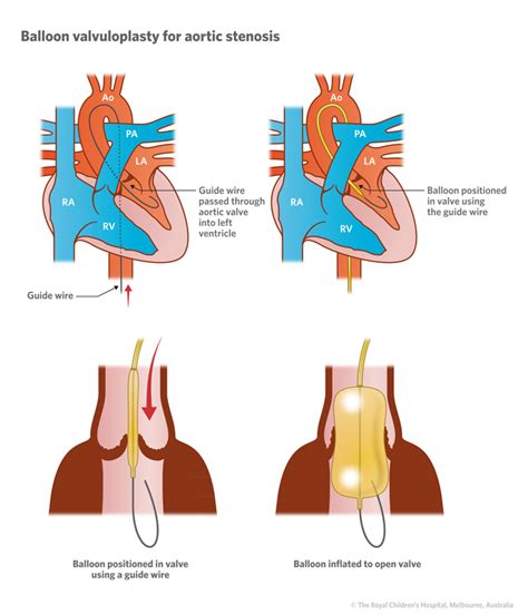 Congenital Aortic Stenosis